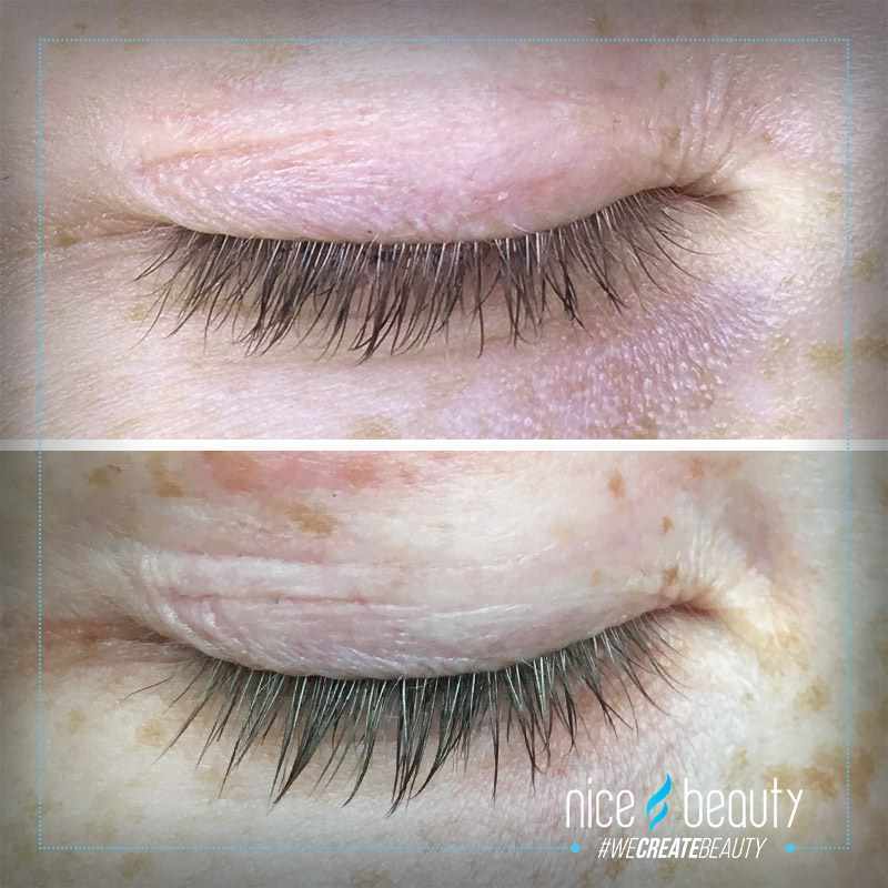 Rønsbøl tegen eczeem